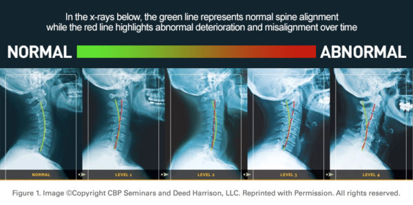 Abnormal Neck Curvatures Are 18 Times More Common in Chronic Neck Pain ...