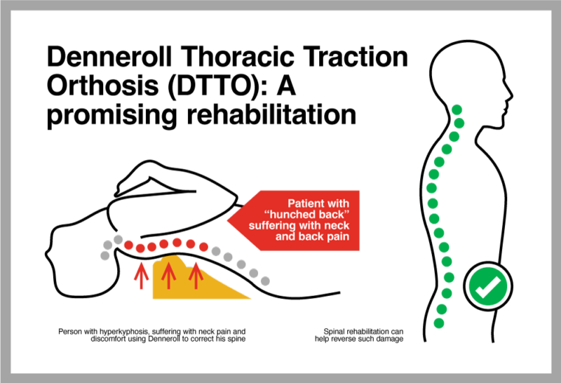 Denneroll™ Thoracic Traction Orthosis (DTTO): A Promising ...