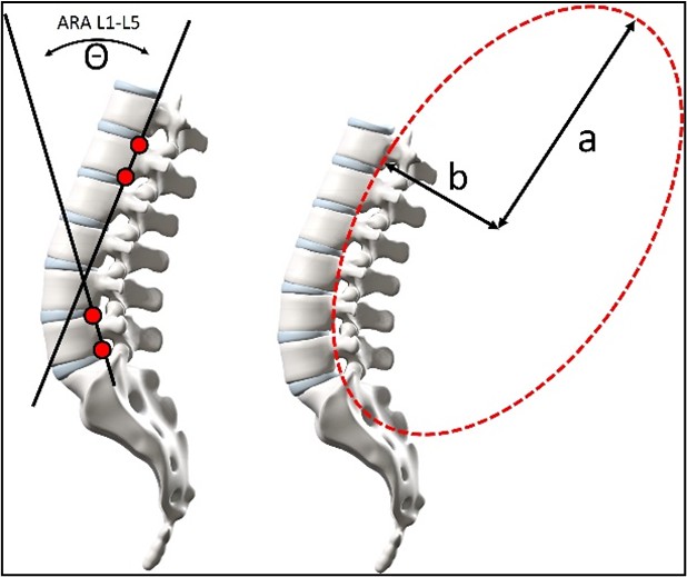 Lumbar Spine Alignment in Acute Low Back Pain: Radiographic Screening ...